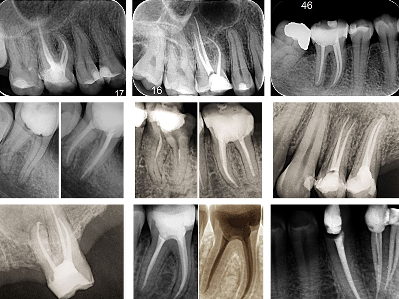 Bolesti zuba i endodoncija | Sačuvajte Vaše zube na vreme